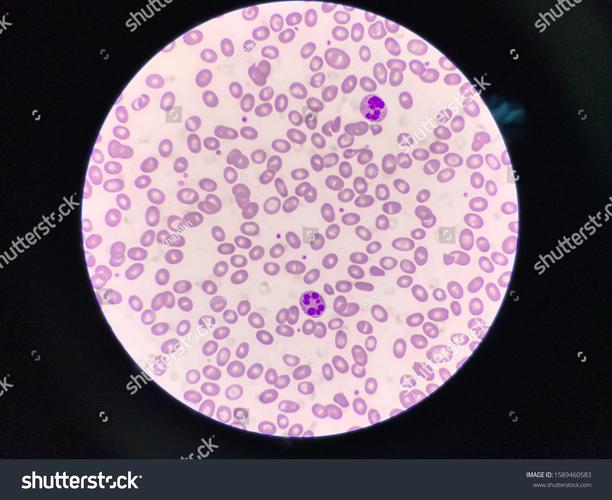 Understanding Elevated FSH Blood Levels in Menopause: Your ...