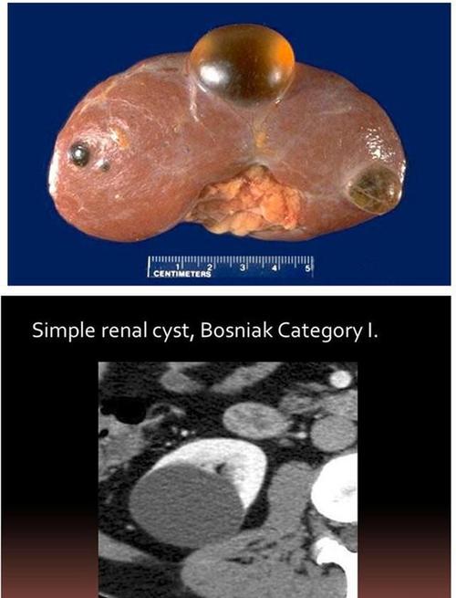 Postmenopausal Simple Ovarian Cyst: Understanding, Management, and ...