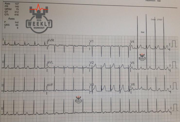 Is Chest Pain Normal for ECG? - Menopause Mastery